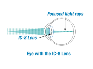 IC-8® Lens Clinical Study | Empire Eye and Laser Center